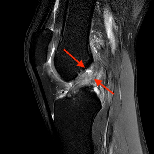 ACL Tear – Dr. Jesper Fritz